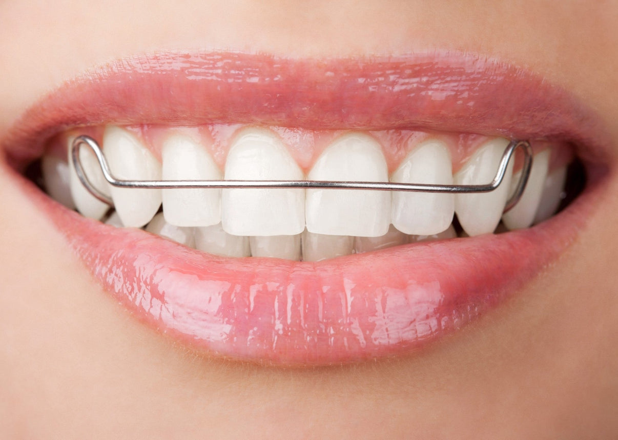 Custom Hawley Retainers Upper / Lower – For All The Smiles